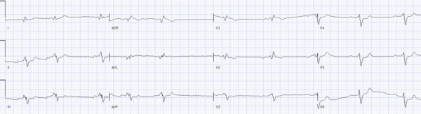 ECG Interpretation in Cardiac Arrest | ECG Cases | Emergency Medicine Cases