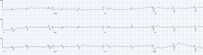 ECG Interpretation in Cardiac Arrest | ECG Cases | Emergency Medicine Cases