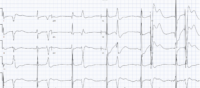 ECG Interpretation in Cardiac Arrest | ECG Cases | Emergency Medicine Cases