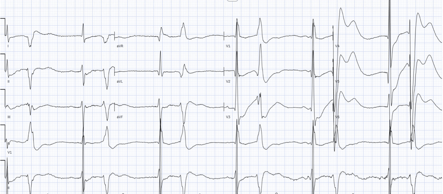 ECG Interpretation in Cardiac Arrest | ECG Cases | Emergency Medicine Cases