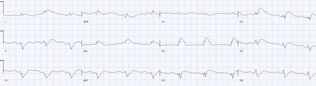 ECG Interpretation in Cardiac Arrest | ECG Cases | Emergency Medicine Cases