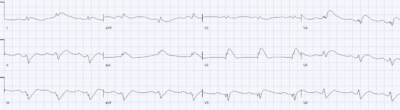 ECG Interpretation in Cardiac Arrest | ECG Cases | Emergency Medicine Cases