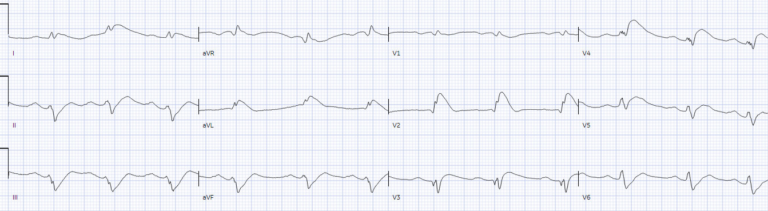 ECG Interpretation in Cardiac Arrest | ECG Cases | Emergency Medicine Cases