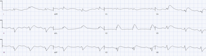 ECG Interpretation in Cardiac Arrest | ECG Cases | Emergency Medicine Cases