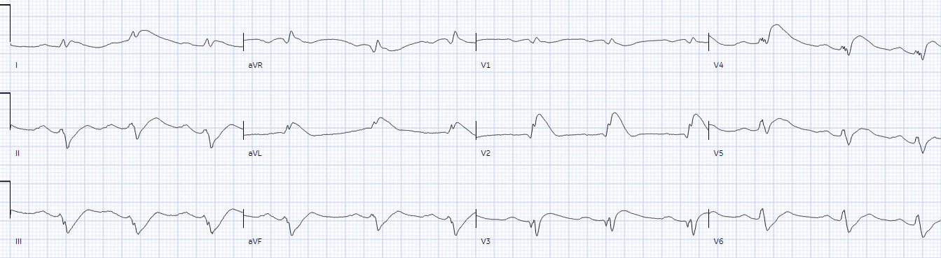 ECG Interpretation in Cardiac Arrest | ECG Cases | Emergency Medicine Cases
