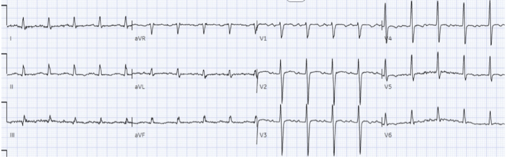 ECG Interpretation in Cardiac Arrest | ECG Cases | Emergency Medicine Cases