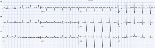 ECG Interpretation in Cardiac Arrest | ECG Cases | Emergency Medicine Cases