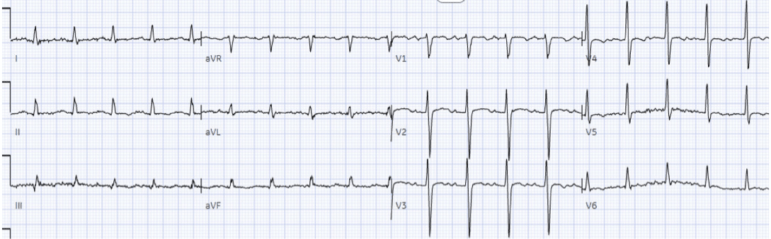 ECG Interpretation in Cardiac Arrest | ECG Cases | Emergency Medicine Cases