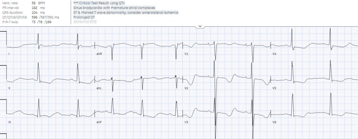 ECG Interpretation in Cardiac Arrest | ECG Cases | Emergency Medicine Cases