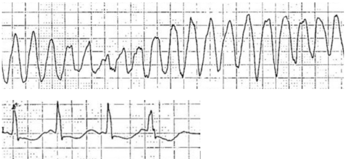 ECG Interpretation in Cardiac Arrest | ECG Cases | Emergency Medicine Cases
