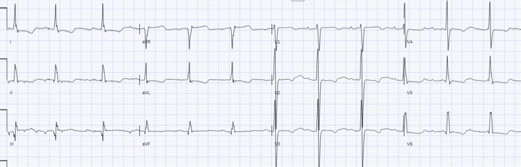 ECG Interpretation in Cardiac Arrest | ECG Cases | Emergency Medicine Cases