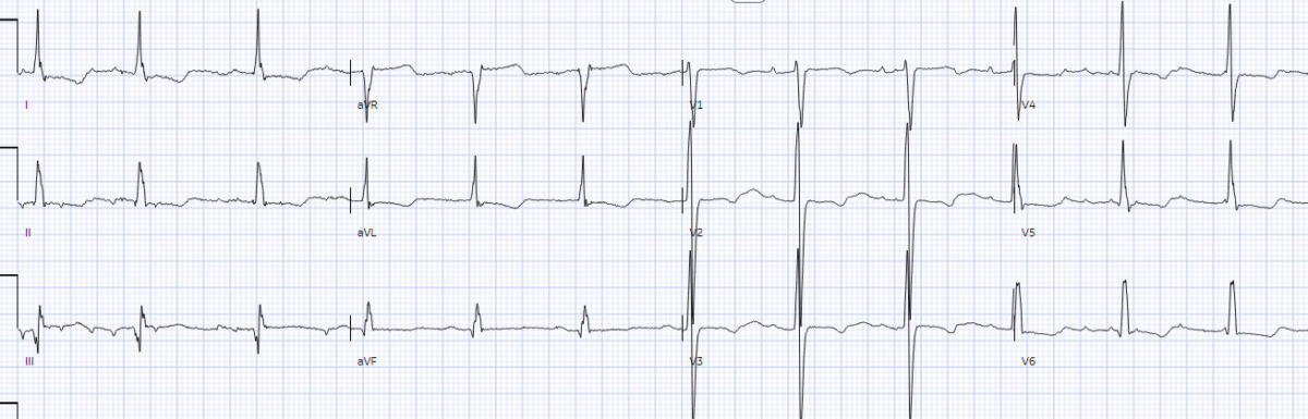 ECG Interpretation in Cardiac Arrest | ECG Cases | Emergency Medicine Cases