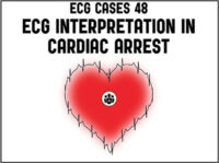 ECG Interpretation in Cardiac Arrest | ECG Cases | Emergency Medicine Cases