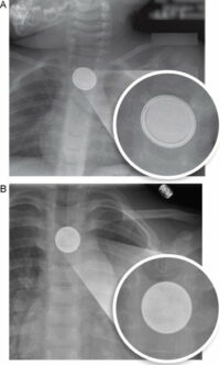 Button Battery Ingestion, C.difficile, Bed Bugs, Fibrinogen in Trauma ...