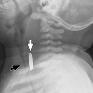 Button Battery Ingestion, C.difficile, Bed Bugs, Fibrinogen in Trauma ...