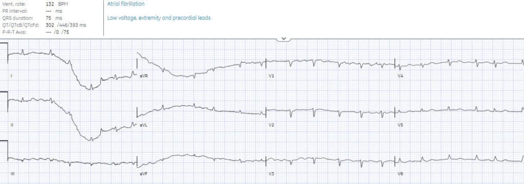 ECG and PoCUS for Chest Pain and Dyspnea | ECG Cases | EM Cases