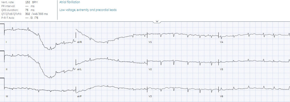 ECG and PoCUS for Chest Pain and Dyspnea | ECG Cases | EM Cases