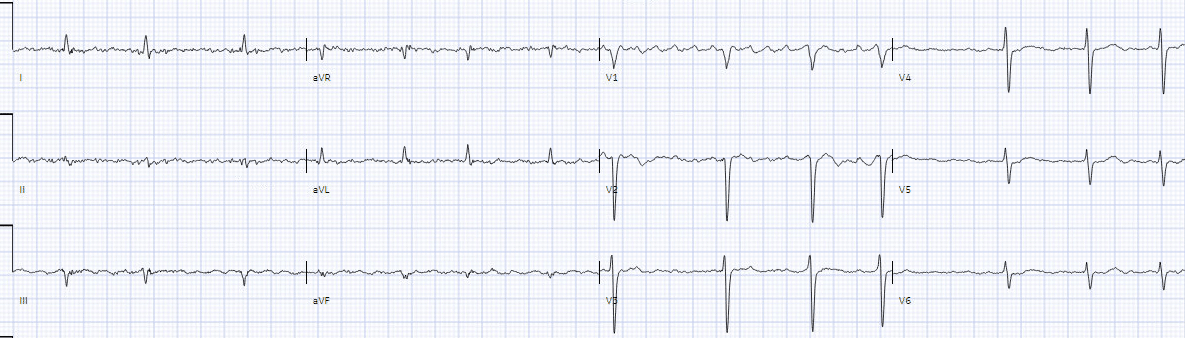 ECG and PoCUS for Chest Pain and Dyspnea | ECG Cases | EM Cases
