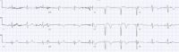 ECG and PoCUS for Chest Pain and Dyspnea | ECG Cases | EM Cases
