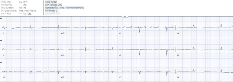 ECG and PoCUS for Chest Pain and Dyspnea | ECG Cases | EM Cases