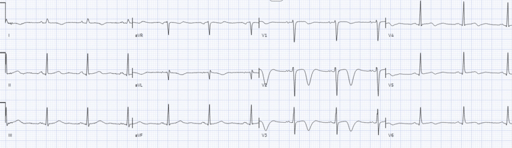 ECG and PoCUS for Chest Pain and Dyspnea | ECG Cases | EM Cases