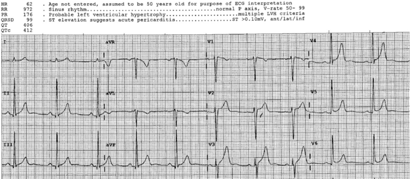 ECG and PoCUS for Chest Pain and Dyspnea | ECG Cases | EM Cases