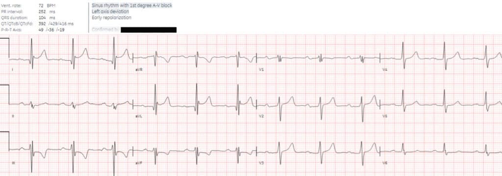 STEMI is a Failed Paradigm, Enter Occlusion MI | ECG Cases | EM Cases