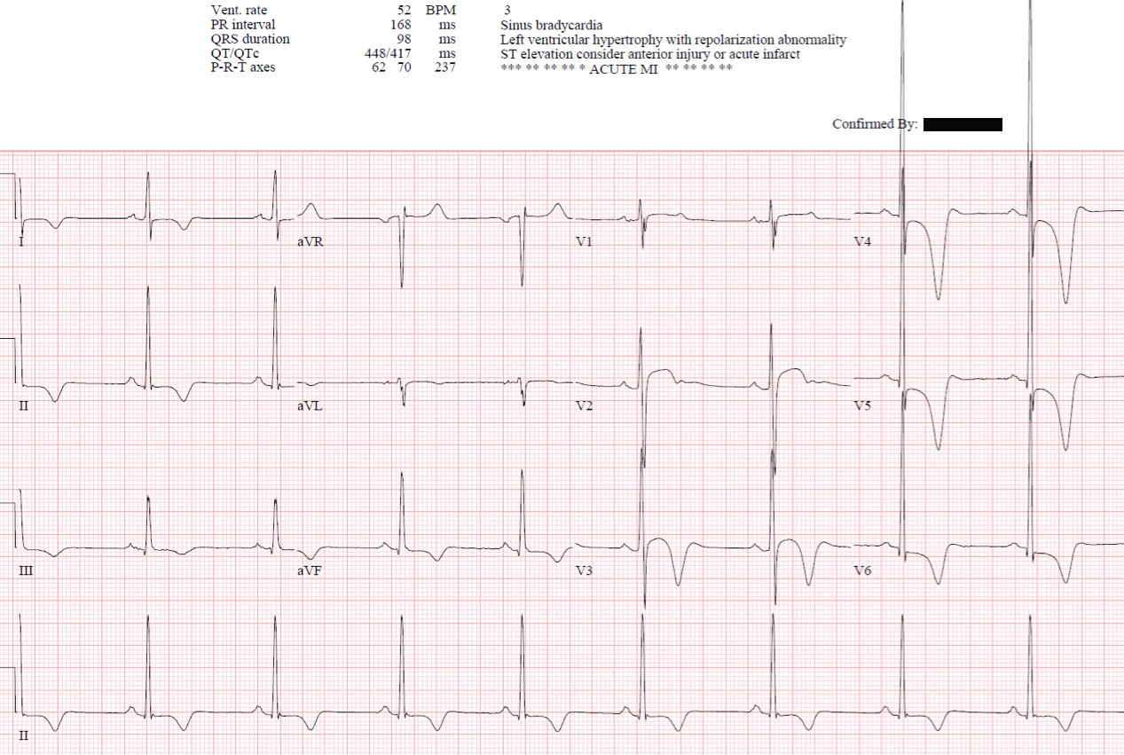 STEMI is a Failed Paradigm, Enter Occlusion MI | ECG Cases | EM Cases