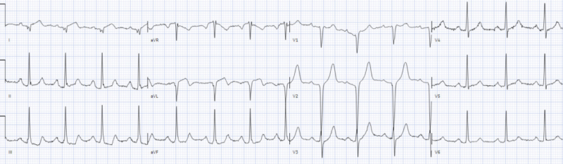 STEMI is a Failed Paradigm, Enter Occlusion MI | ECG Cases | EM Cases