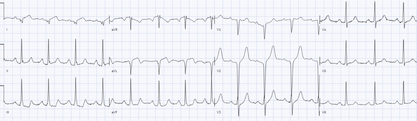 STEMI is a Failed Paradigm, Enter Occlusion MI | ECG Cases | EM Cases