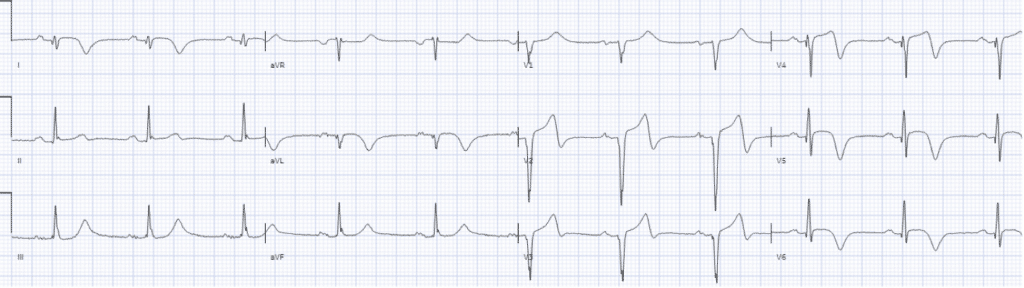 STEMI is a Failed Paradigm, Enter Occlusion MI | ECG Cases | EM Cases