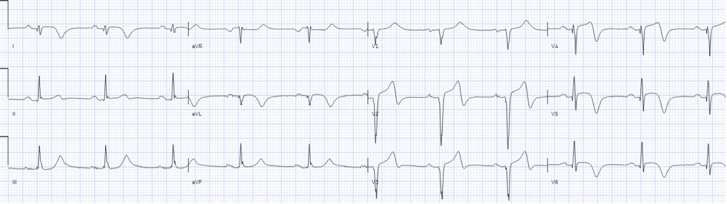 STEMI is a Failed Paradigm, Enter Occlusion MI | ECG Cases | EM Cases