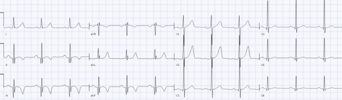 STEMI is a Failed Paradigm, Enter Occlusion MI | ECG Cases | EM Cases