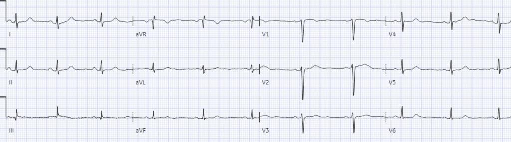 ECG artifact and lead misplacement | ECG Cases | EM Cases