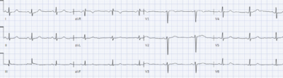 ECG artifact and lead misplacement | ECG Cases | EM Cases
