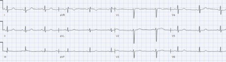 ECG artifact and lead misplacement | ECG Cases | EM Cases