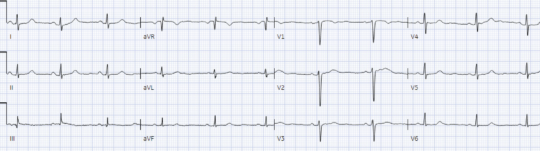 ECG artifact and lead misplacement | ECG Cases | EM Cases