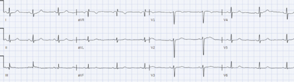 ECG artifact and lead misplacement | ECG Cases | EM Cases