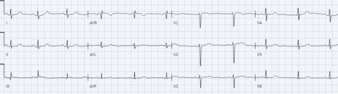 ECG artifact and lead misplacement | ECG Cases | EM Cases