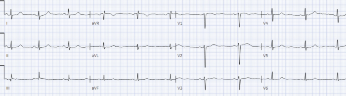 ECG artifact and lead misplacement | ECG Cases | EM Cases