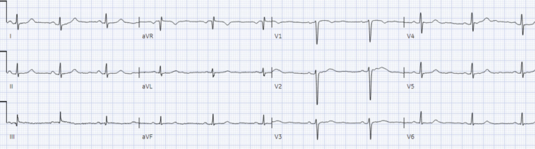 ECG artifact and lead misplacement | ECG Cases | EM Cases