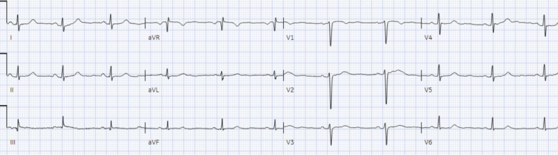ECG artifact and lead misplacement | ECG Cases | EM Cases