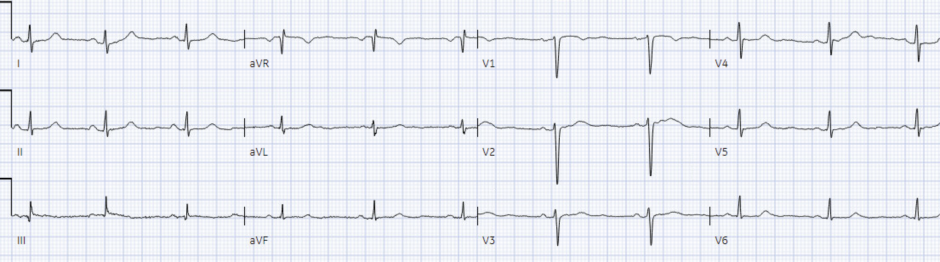 ECG artifact and lead misplacement | ECG Cases | EM Cases