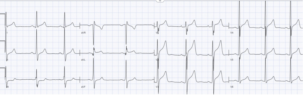 ECG artifact and lead misplacement | ECG Cases | EM Cases