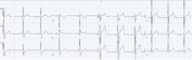 ECG artifact and lead misplacement | ECG Cases | EM Cases