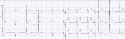 ECG artifact and lead misplacement | ECG Cases | EM Cases
