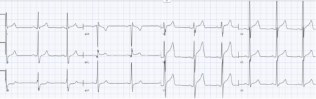 ECG artifact and lead misplacement | ECG Cases | EM Cases