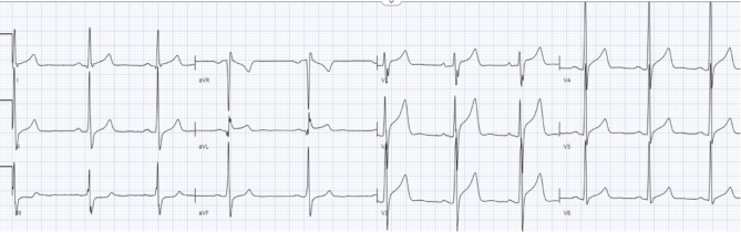 ECG artifact and lead misplacement | ECG Cases | EM Cases
