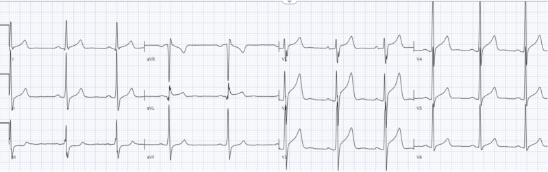 ECG artifact and lead misplacement | ECG Cases | EM Cases