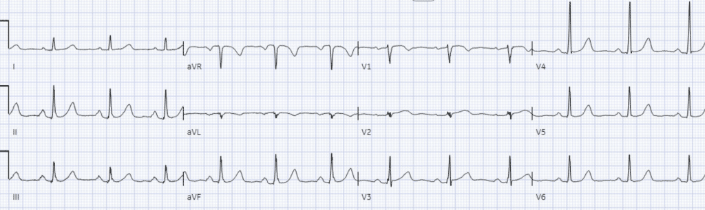 ECG artifact and lead misplacement | ECG Cases | EM Cases